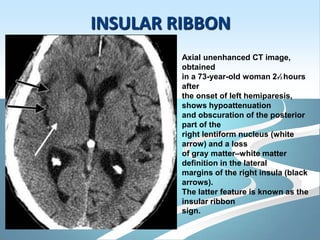 Insular Ribbon Sign