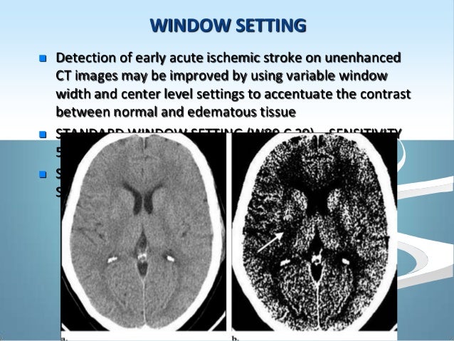 Imaging in stroke