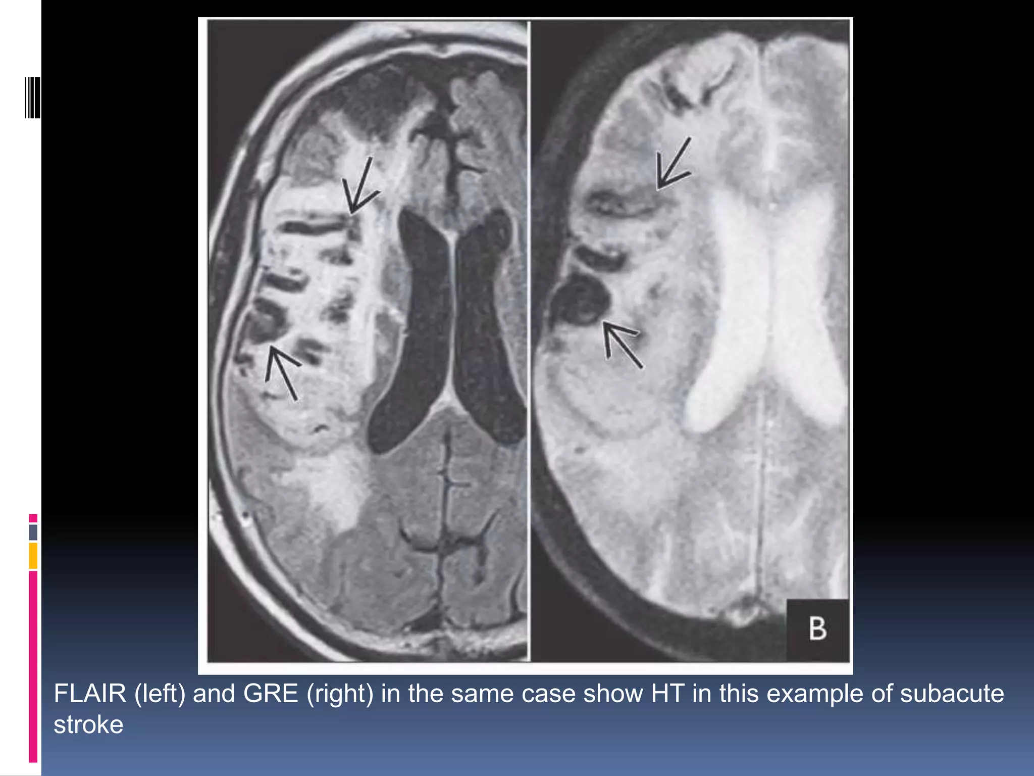 Imaging in stroke | PPTX
