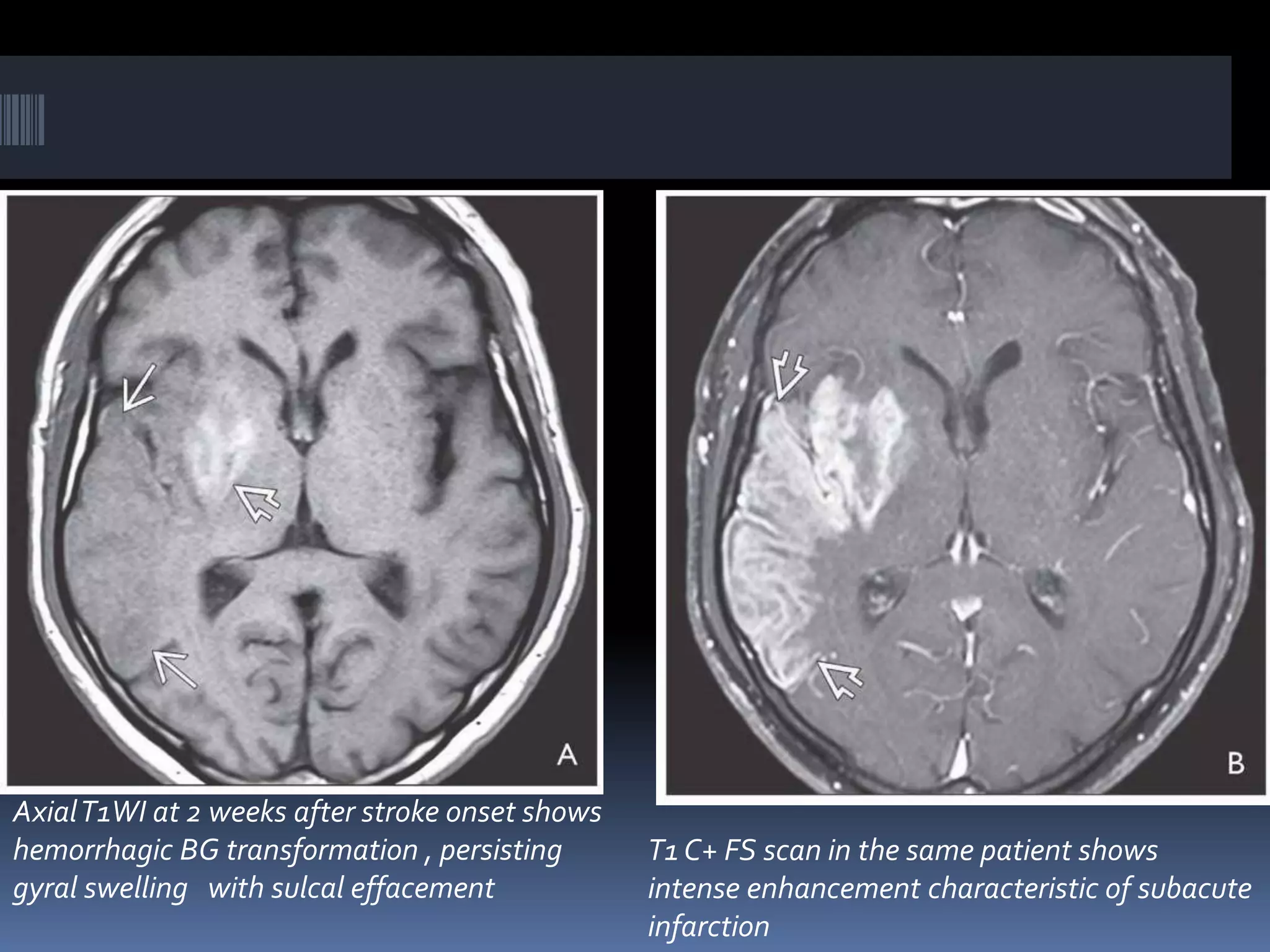 Imaging in stroke | PPTX