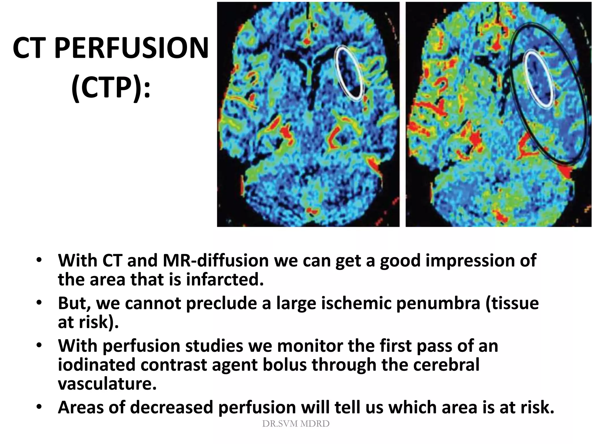 Imaging in stroke | PPTX
