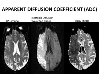 Imaging in stroke | PPT