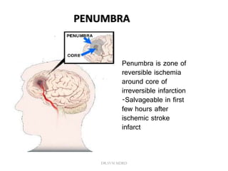 Ischemic Stroke Penumbra