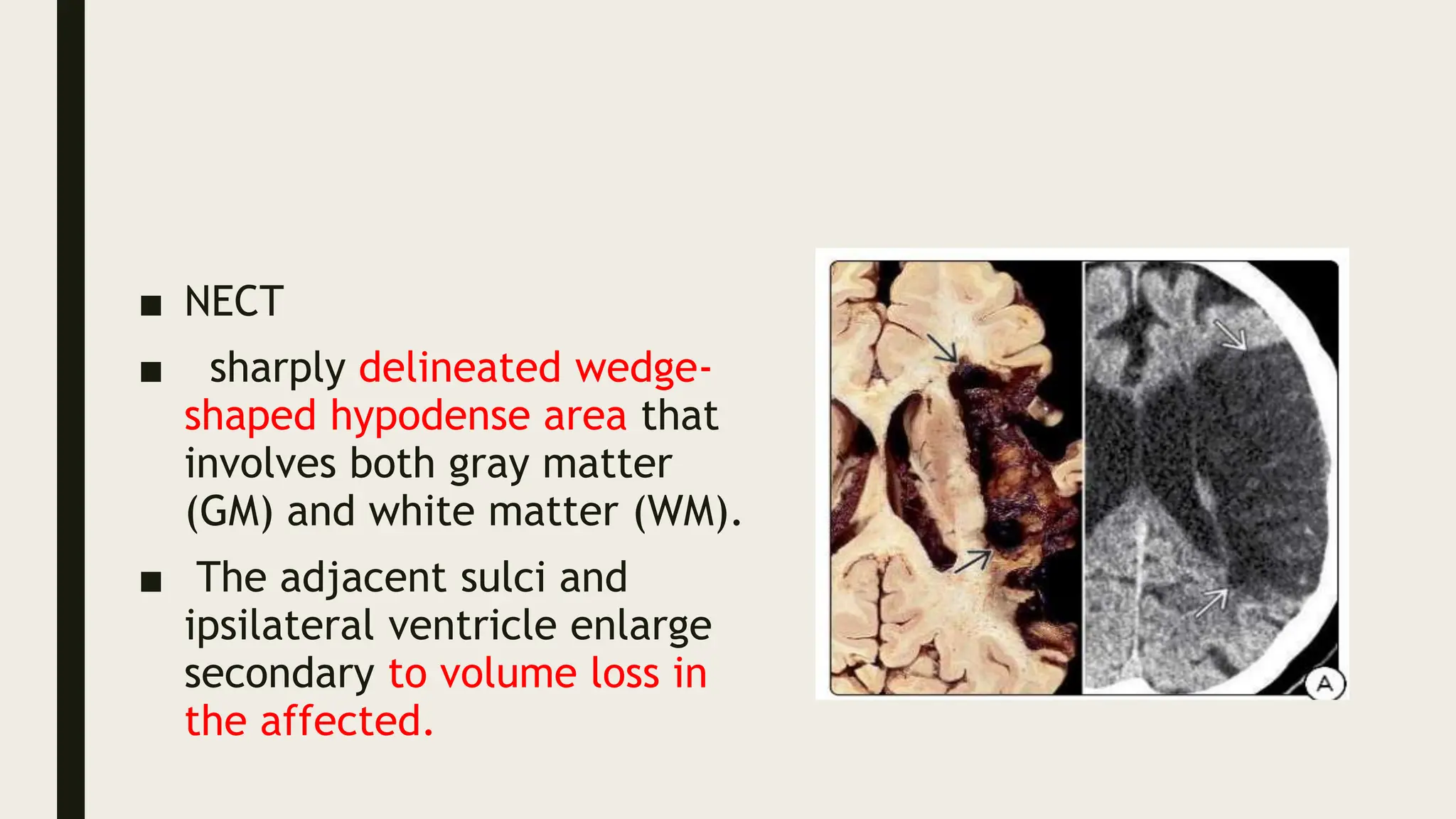IMAGING IN STROKE.pptxIMAGING IN STROKE.pptx
