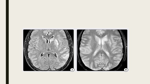 IMAGING IN STROKE.pptxIMAGING IN STROKE.pptx