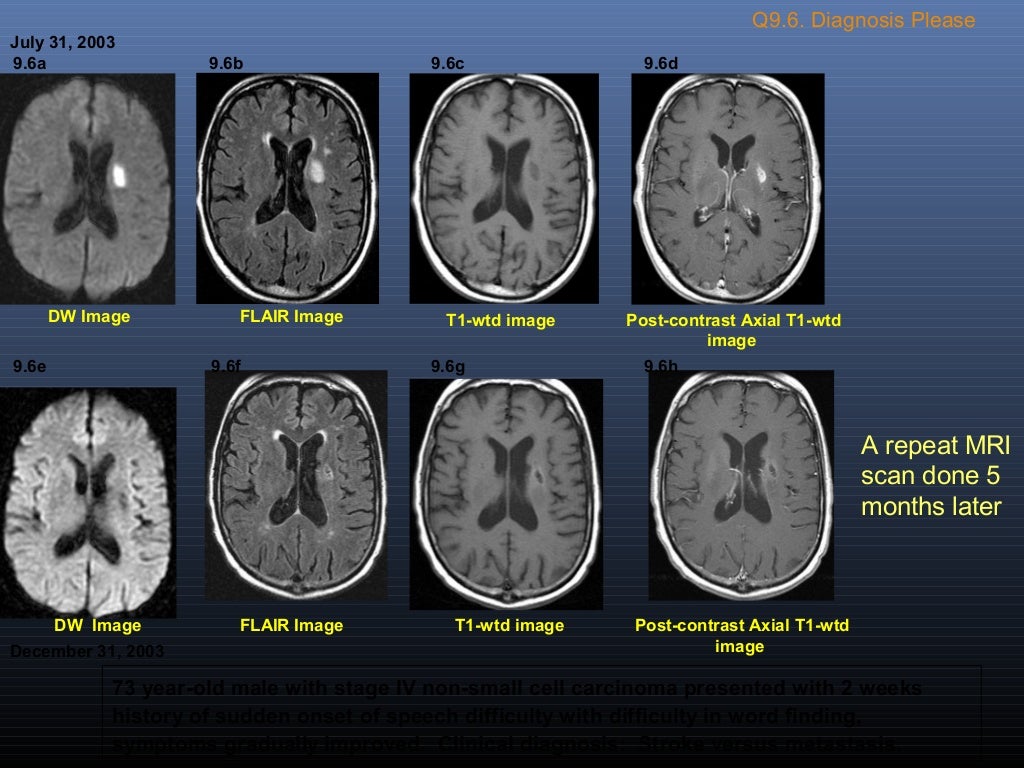 Imaging in stroke
