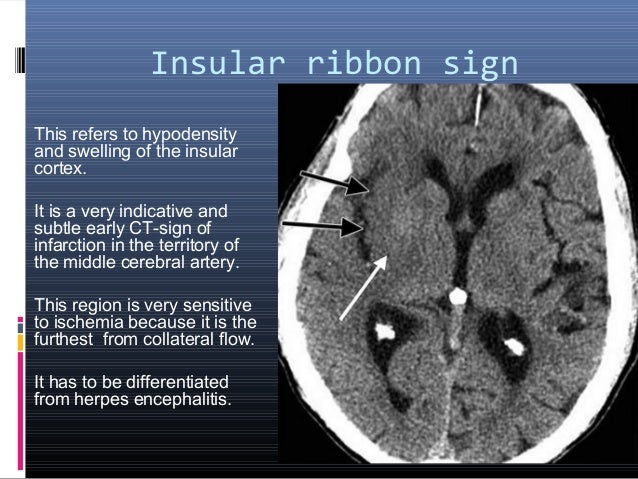 Imaging in stroke