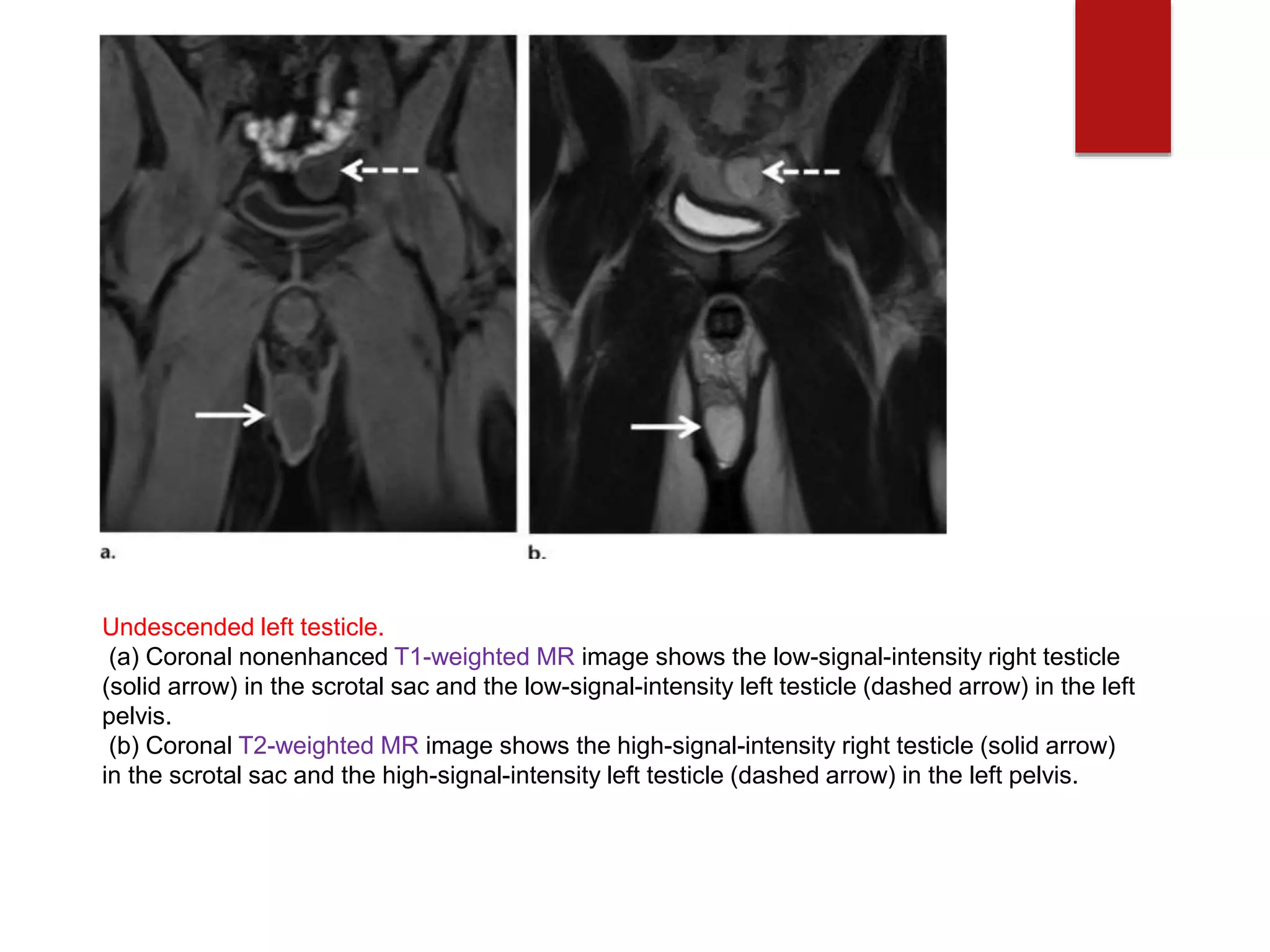 Imaging in testicular tumor | PPTX