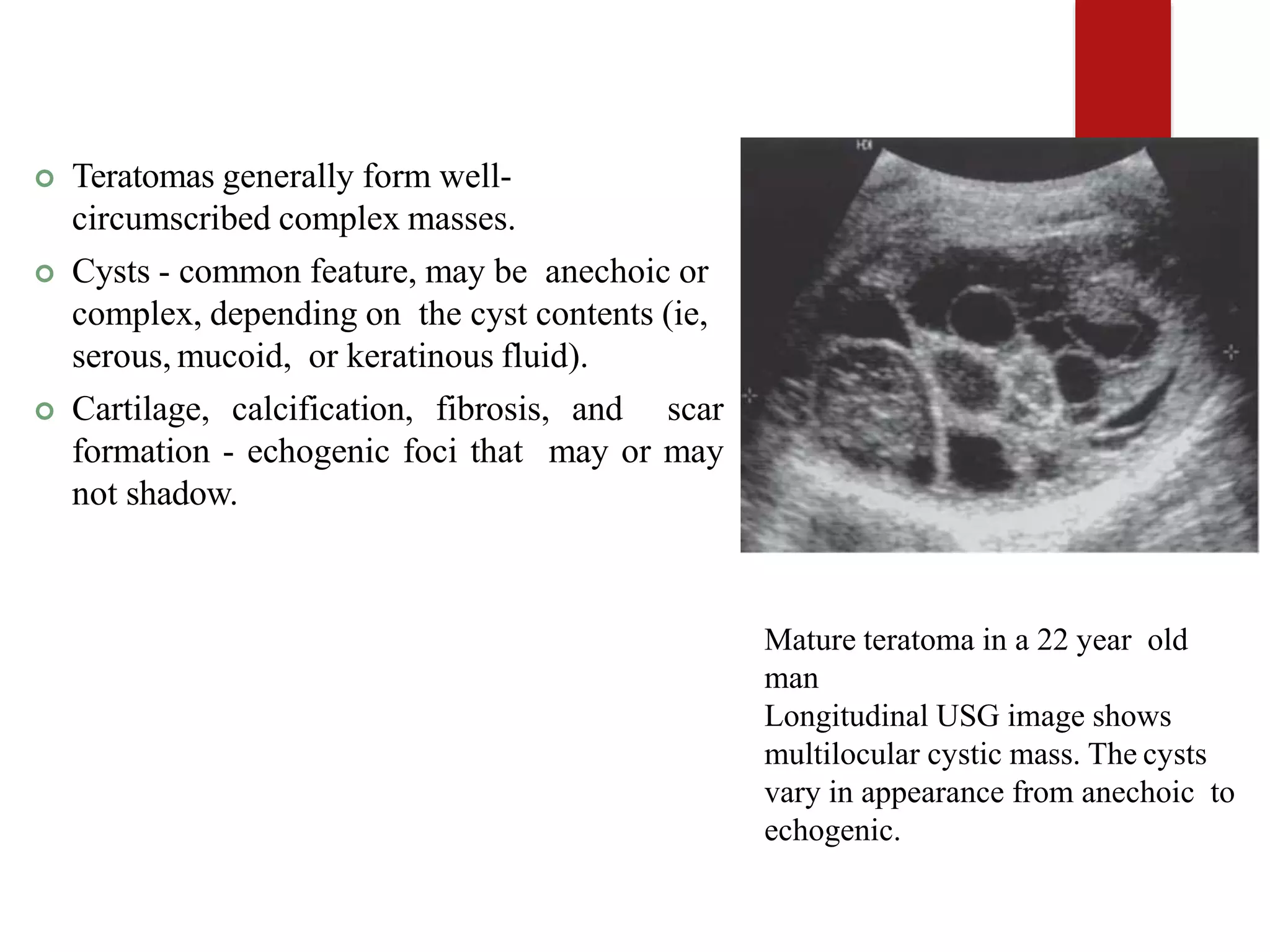 Imaging in testicular tumor | PPTX