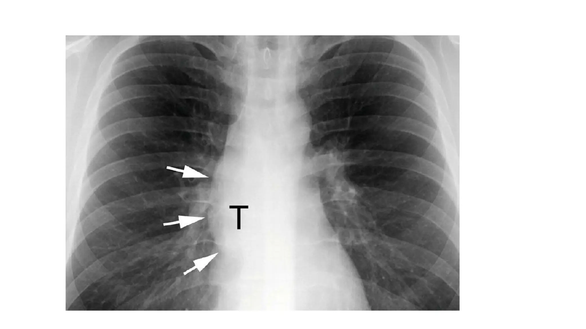 IMAGING IN THYMIC LESIONS radiology presentation | PPTX