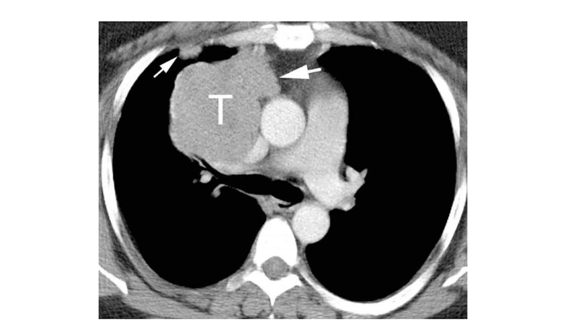 IMAGING IN THYMIC LESIONS radiology presentation | PPTX