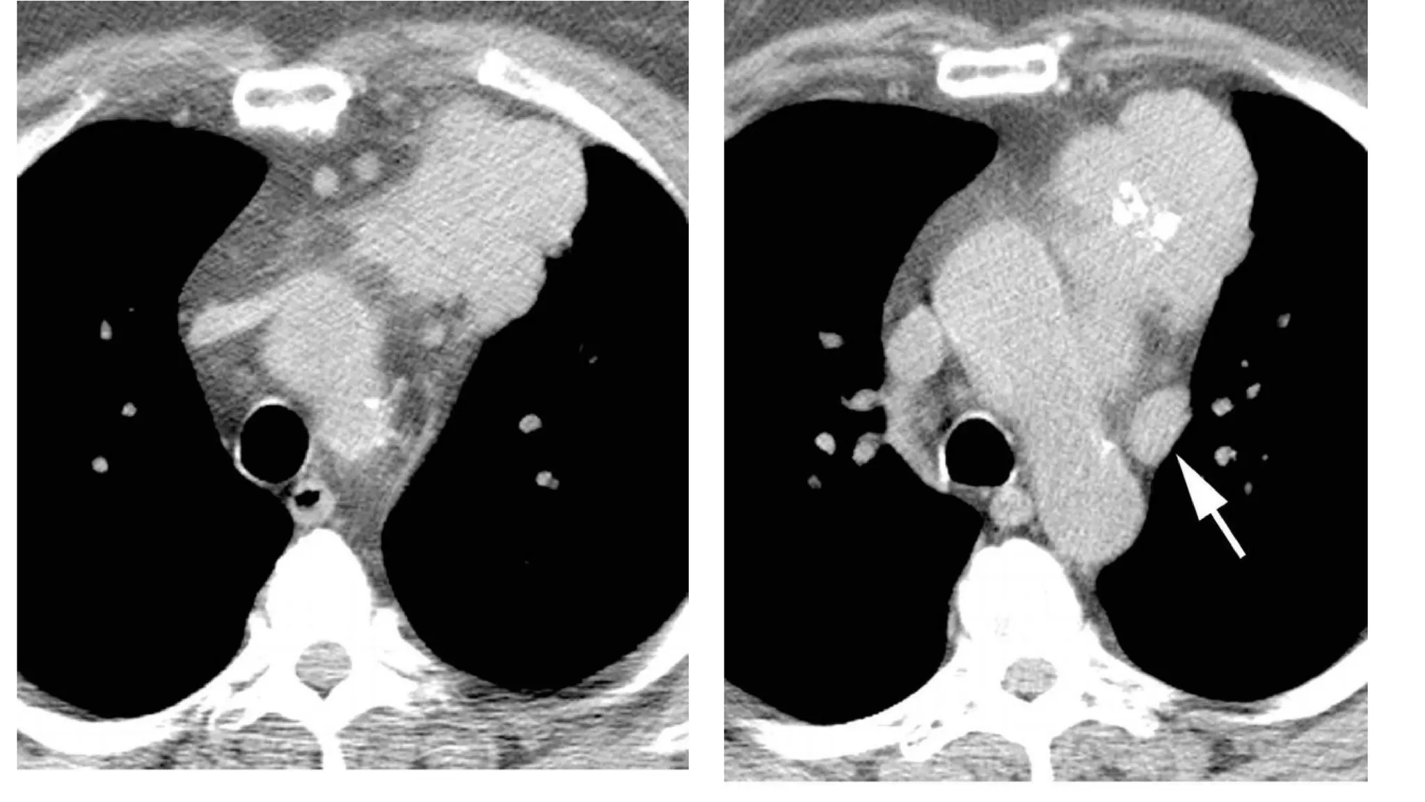 IMAGING IN THYMIC LESIONS radiology presentation | PPTX