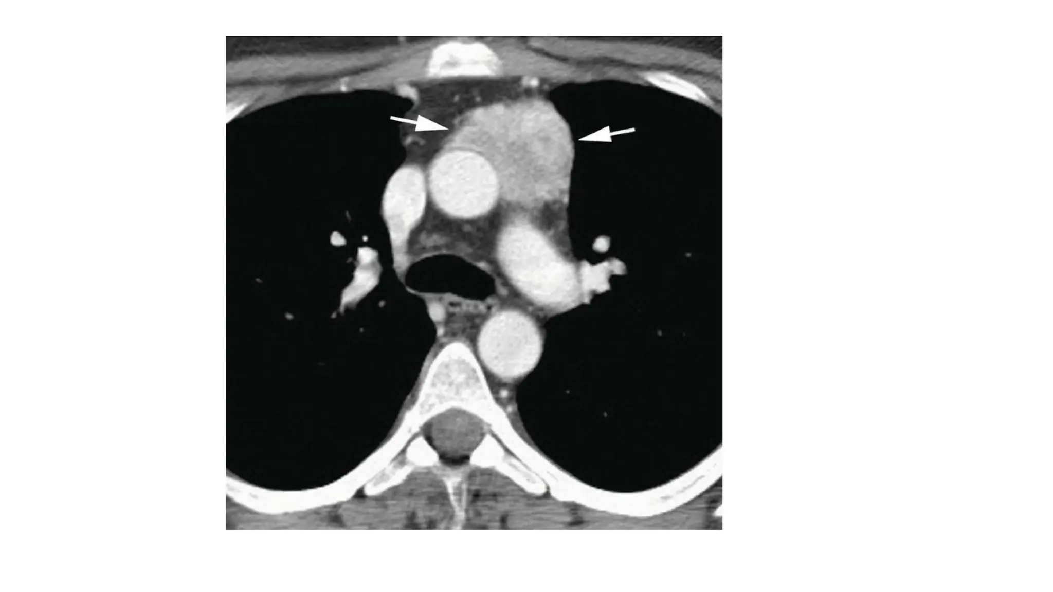IMAGING IN THYMIC LESIONS radiology presentation | PPTX