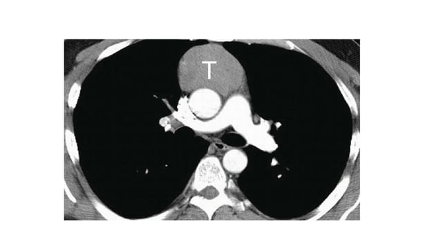 IMAGING IN THYMIC LESIONS radiology presentation | PPTX