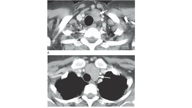 IMAGING IN THYMIC LESIONS radiology presentation | PPTX