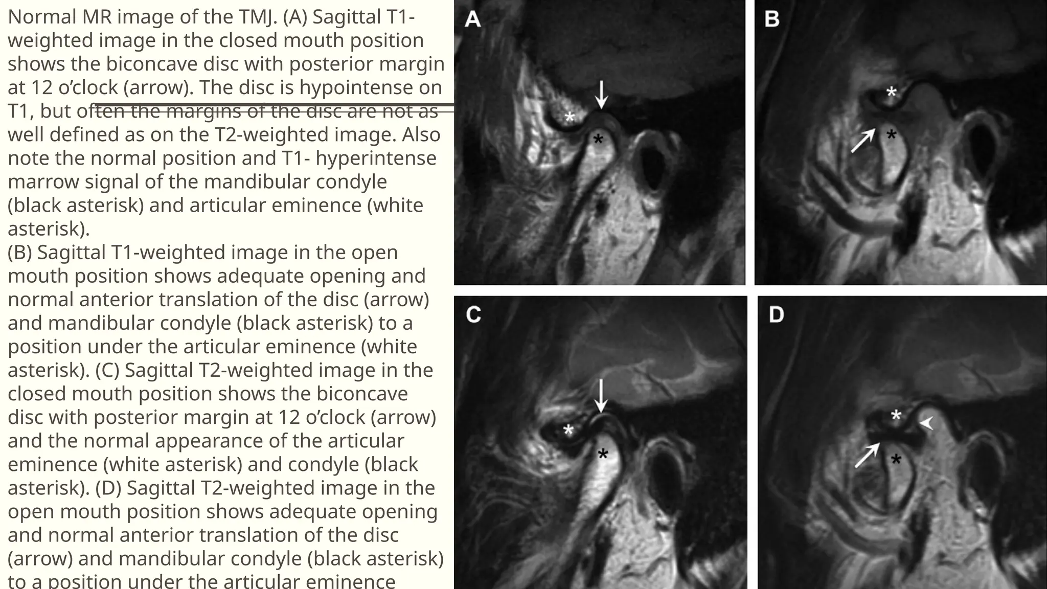 Imaging Modalities in Temporomandibular Joint.pptx