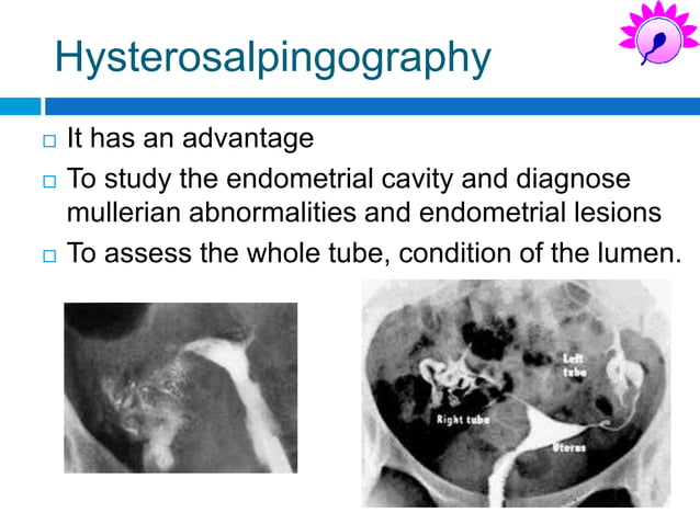 Imaging in tubal factors in infertility. | PPT Imaging in tubal factors in infertility. | PPT