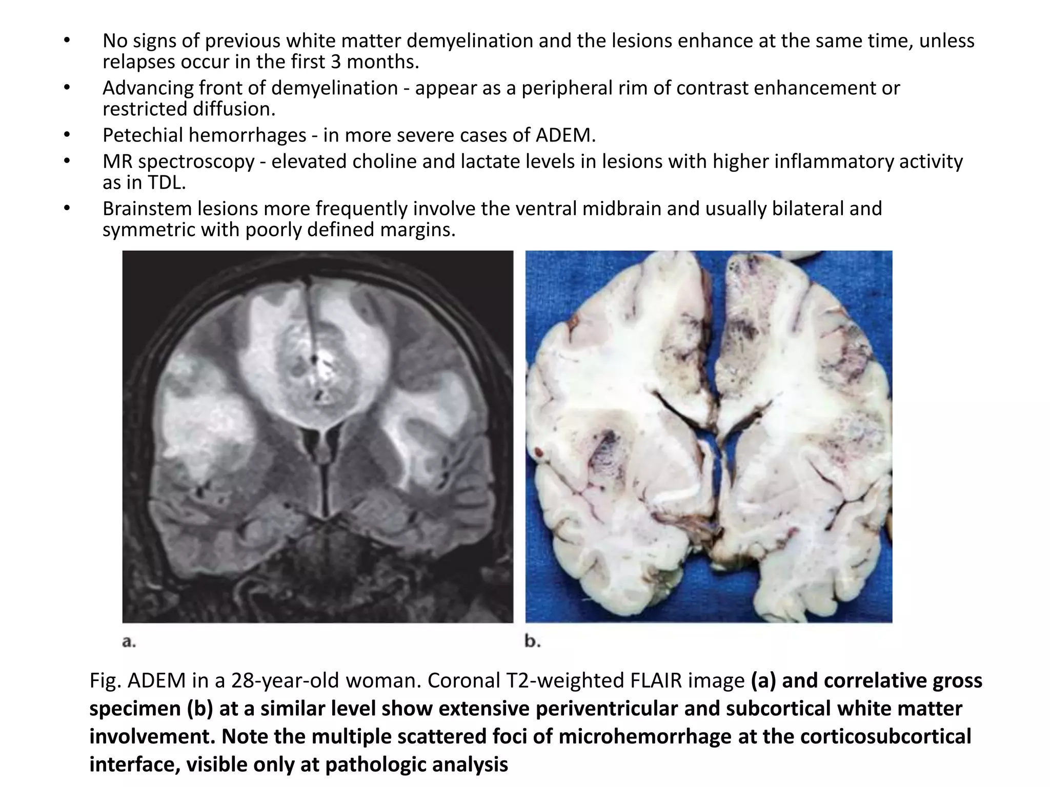 Imaging in white matter disorders gt | PPTX