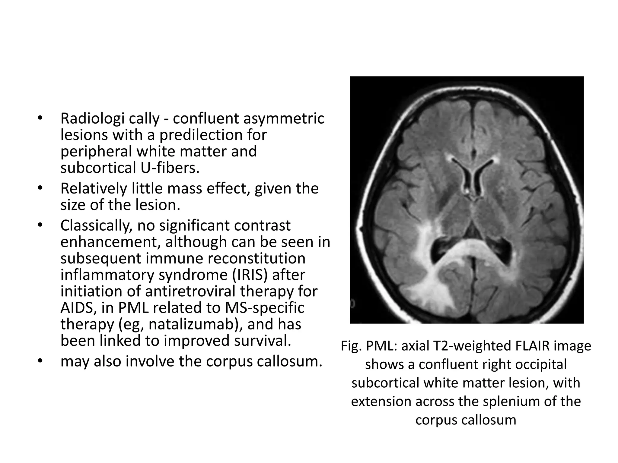 Imaging in white matter disorders gt | PPTX