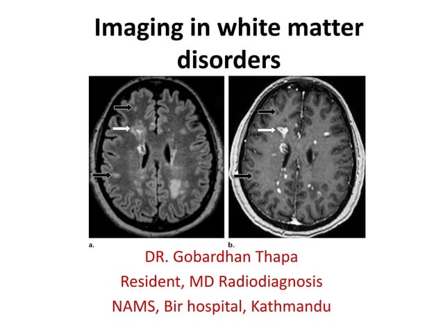 Imaging in white matter disorders gt | PPT