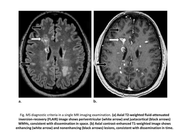 Imaging in white matter disorders gt | PPT