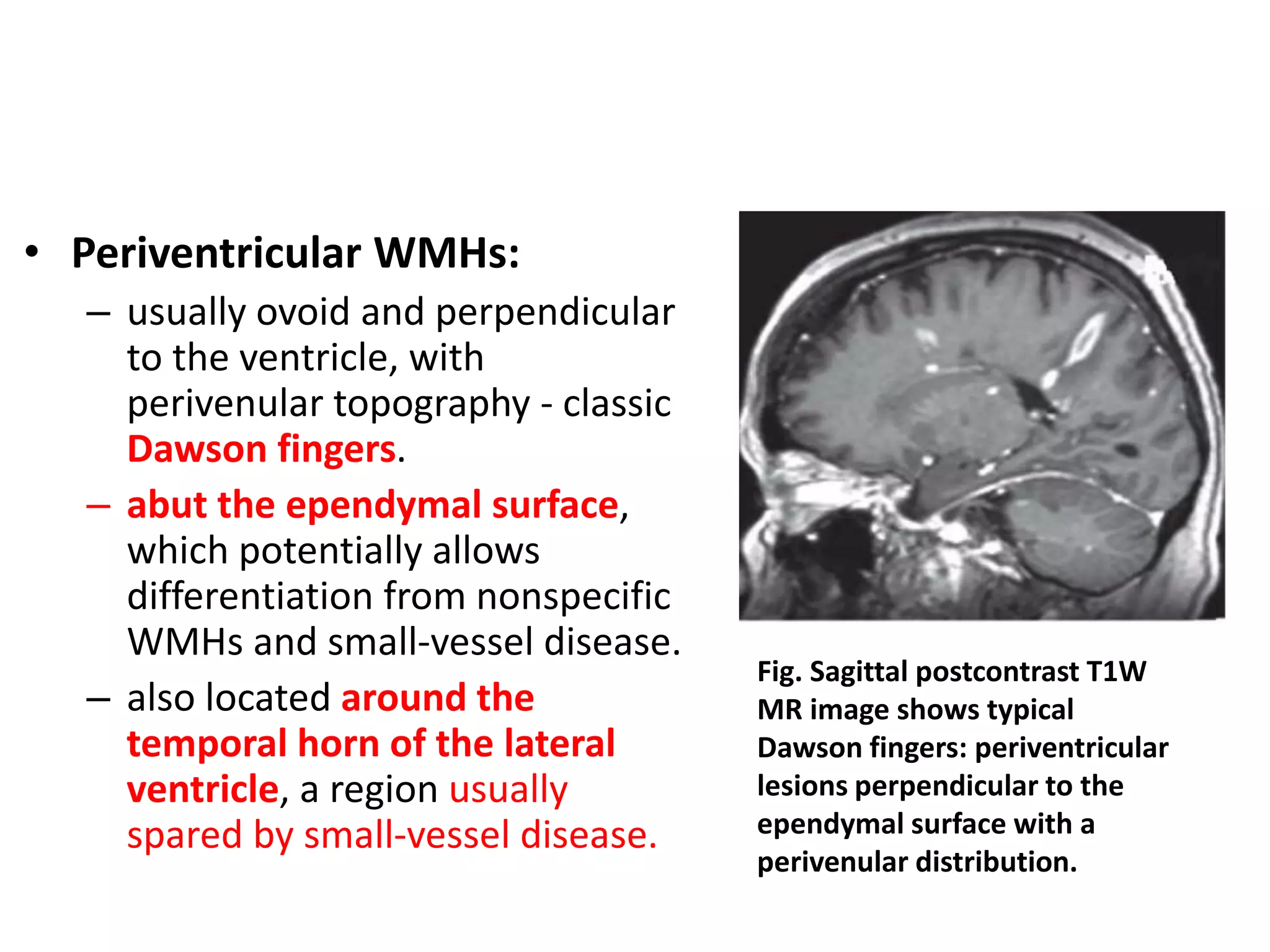 Imaging in white matter disorders | PPTX