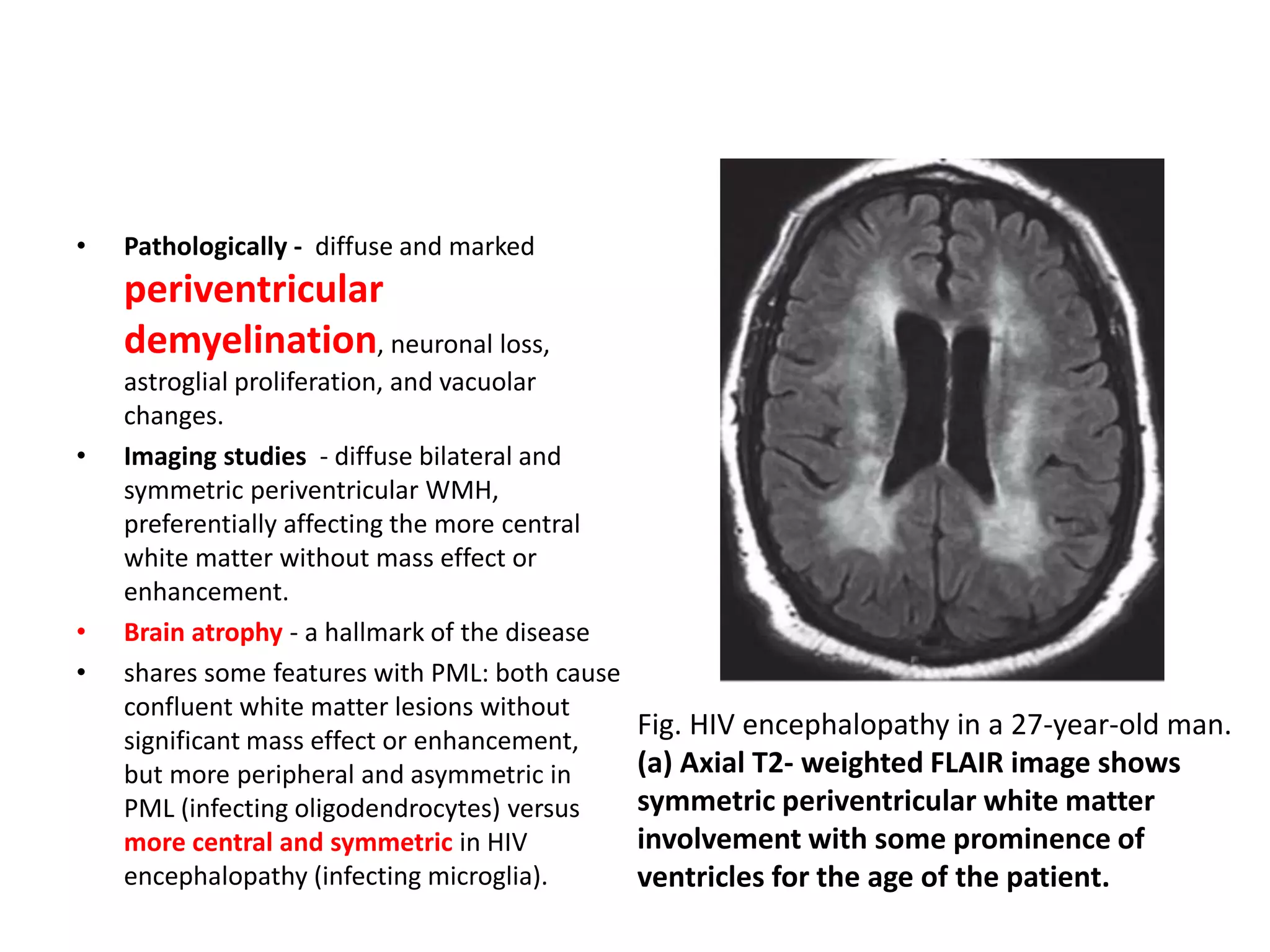 Imaging in white matter disorders | PPTX