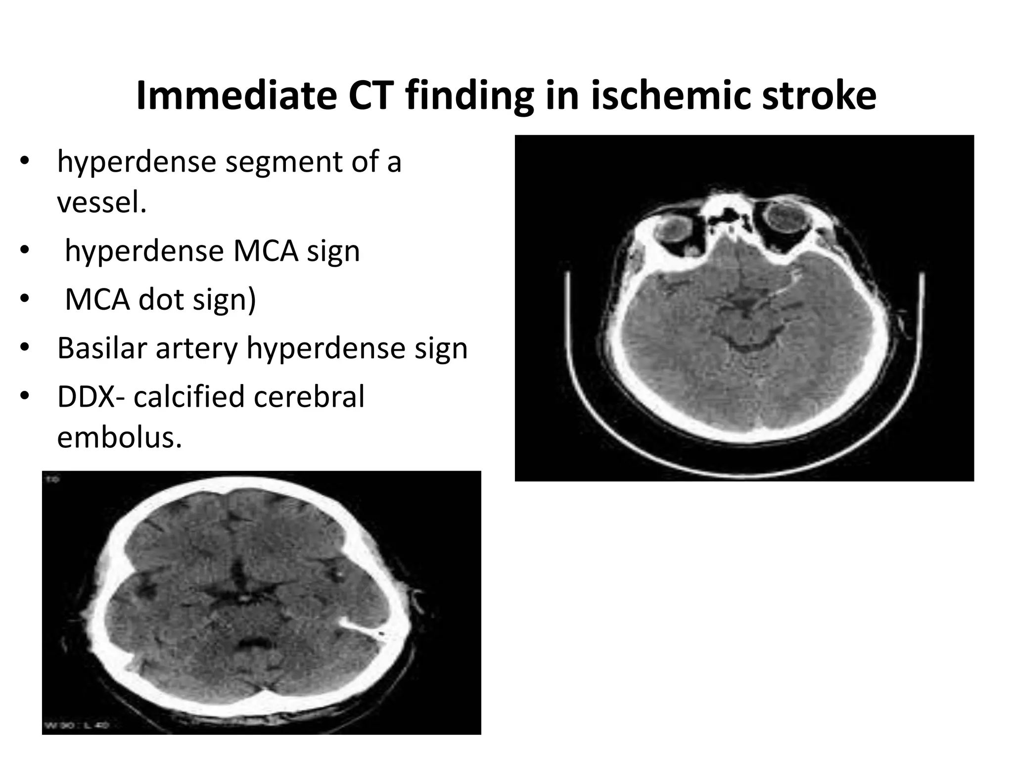 Imaging ischemic infarction.pptx