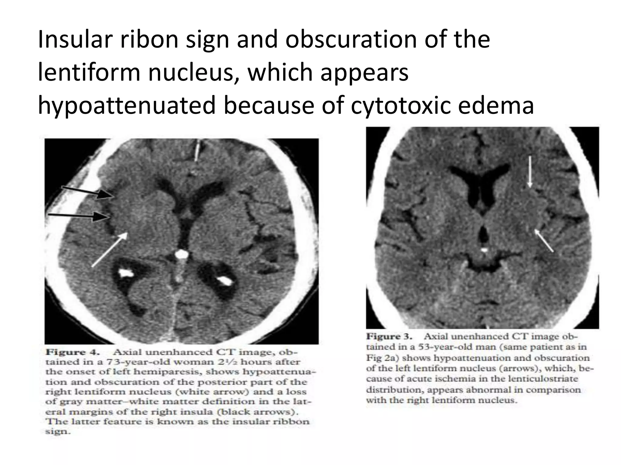 Imaging ischemic infarction.pptx