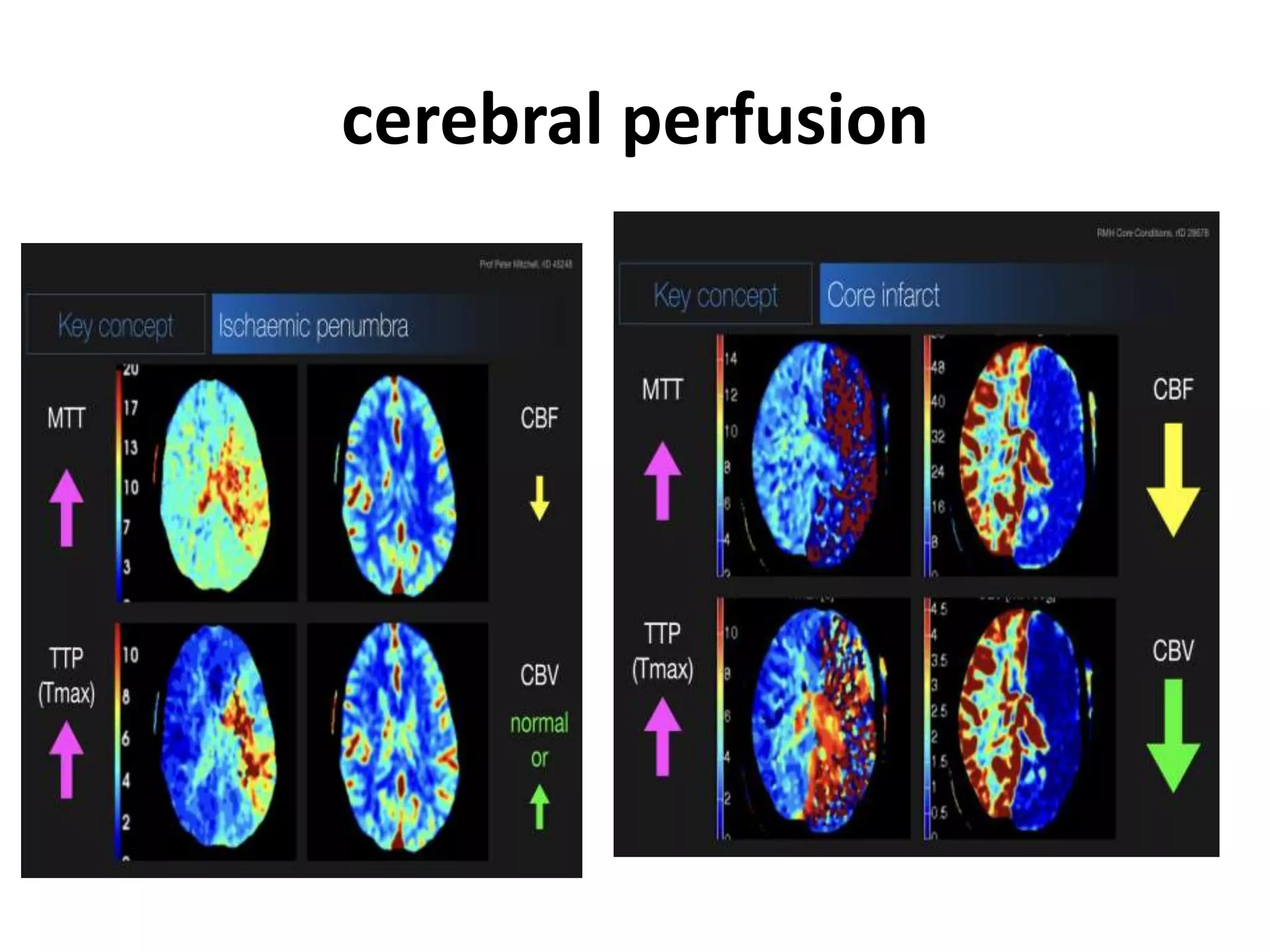 Imaging ischemic infarction.pptx