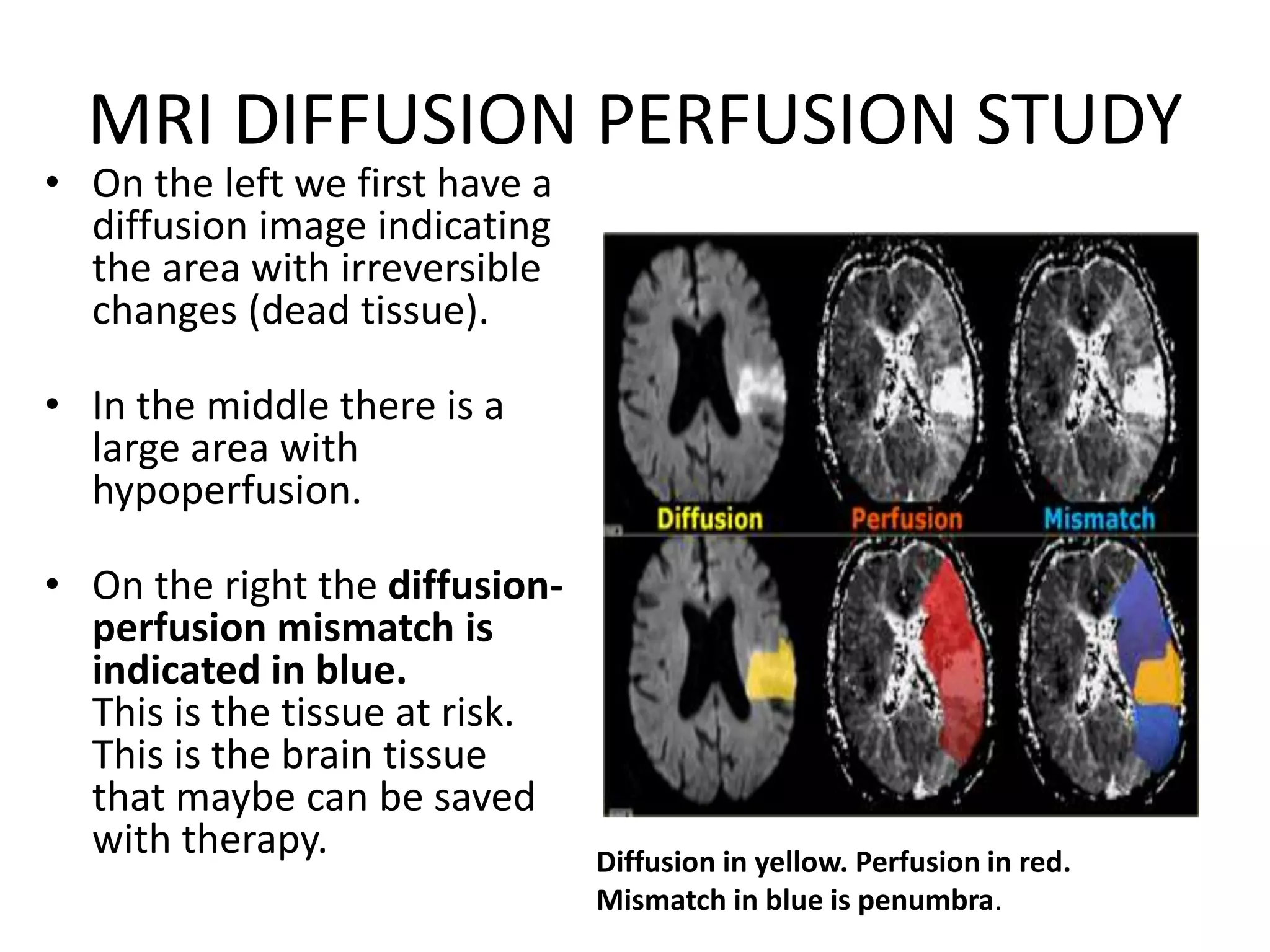 Imaging ischemic infarction.pptx