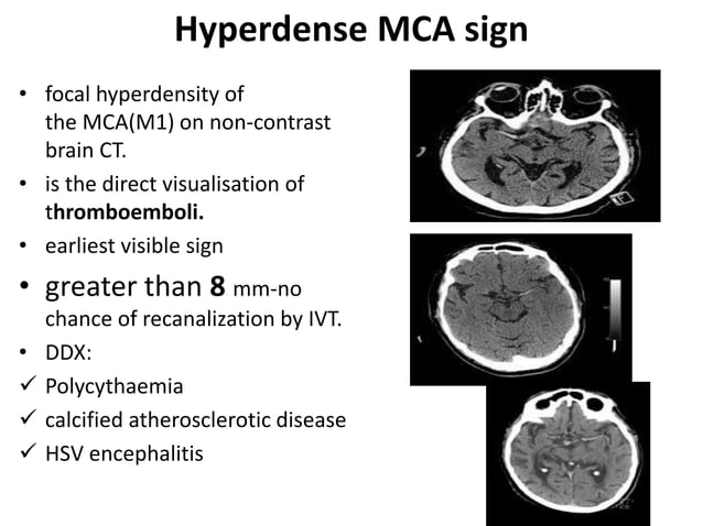 Imaging ischemic infarction.pptx
