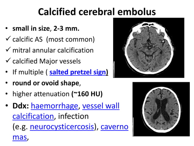 Imaging ischemic infarction.pptx