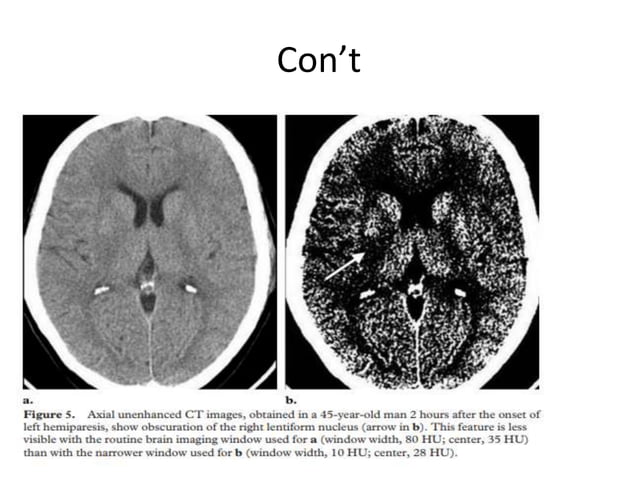 Imaging ischemic infarction.pptx