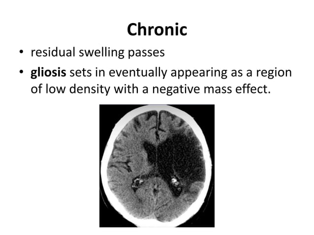 Imaging ischemic infarction.pptx