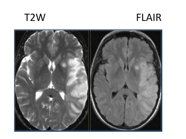 Imaging ischemic infarction.pptx