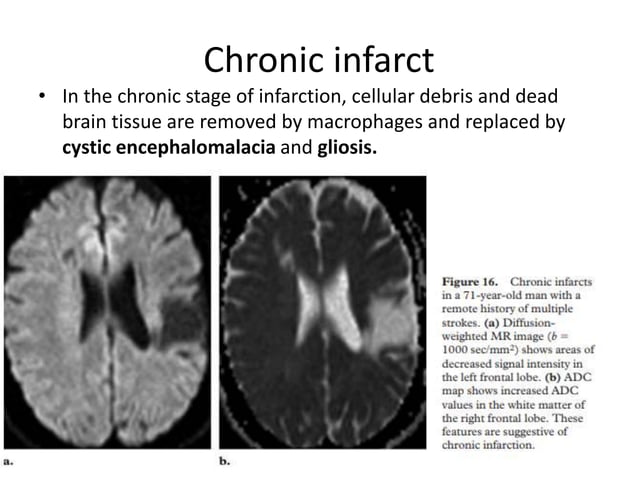 Imaging ischemic infarction.pptx