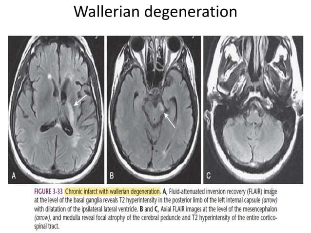 Imaging ischemic infarction.pptx