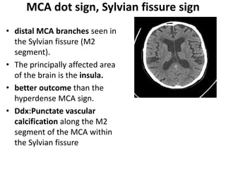 Imaging ischemic infarction.pptx