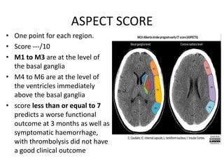 Imaging ischemic infarction.pptx