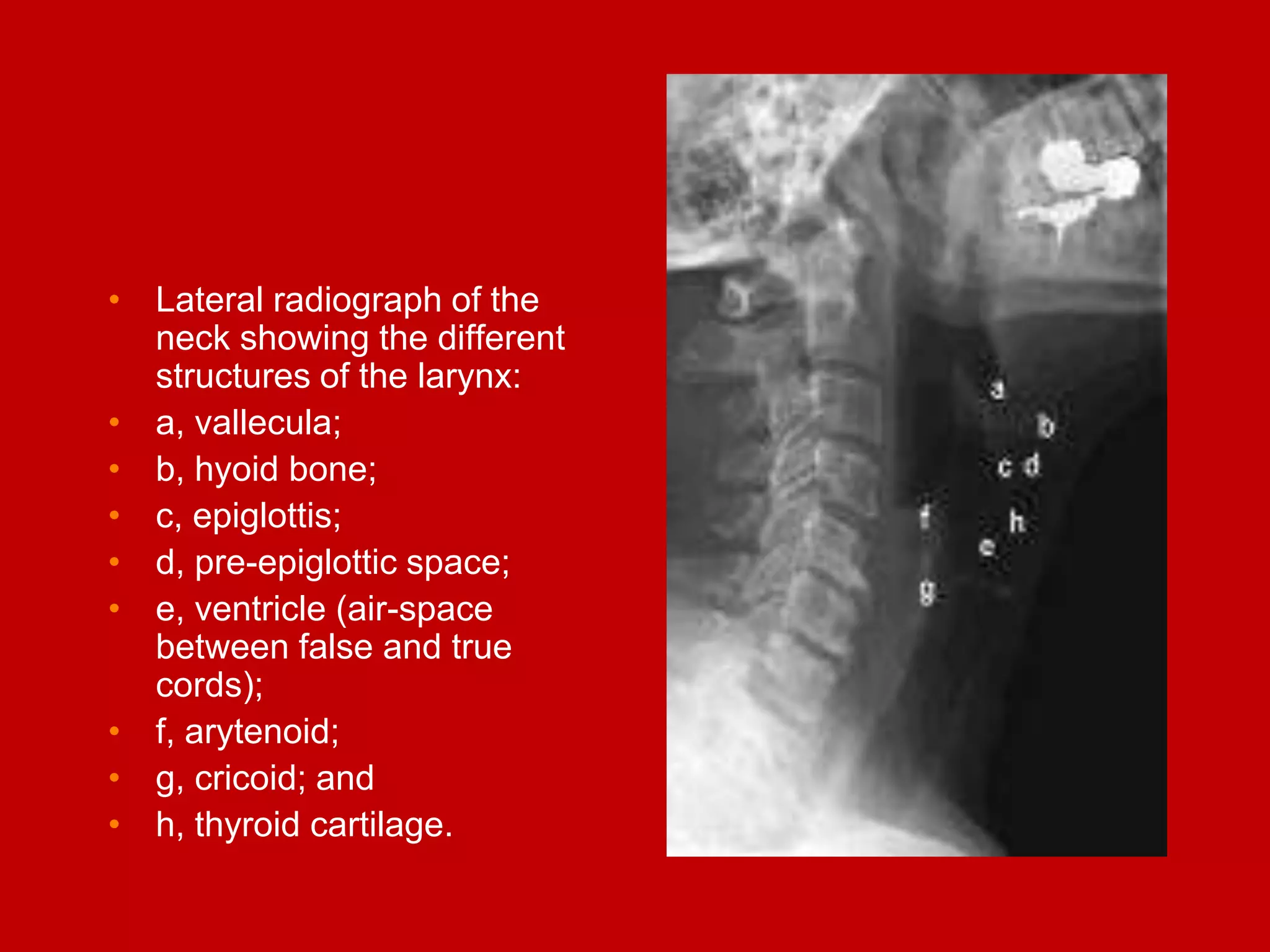 larynx Imaging 1st part laryngeal anatomy CT MRI Dr Ahmed Esawy | PDF