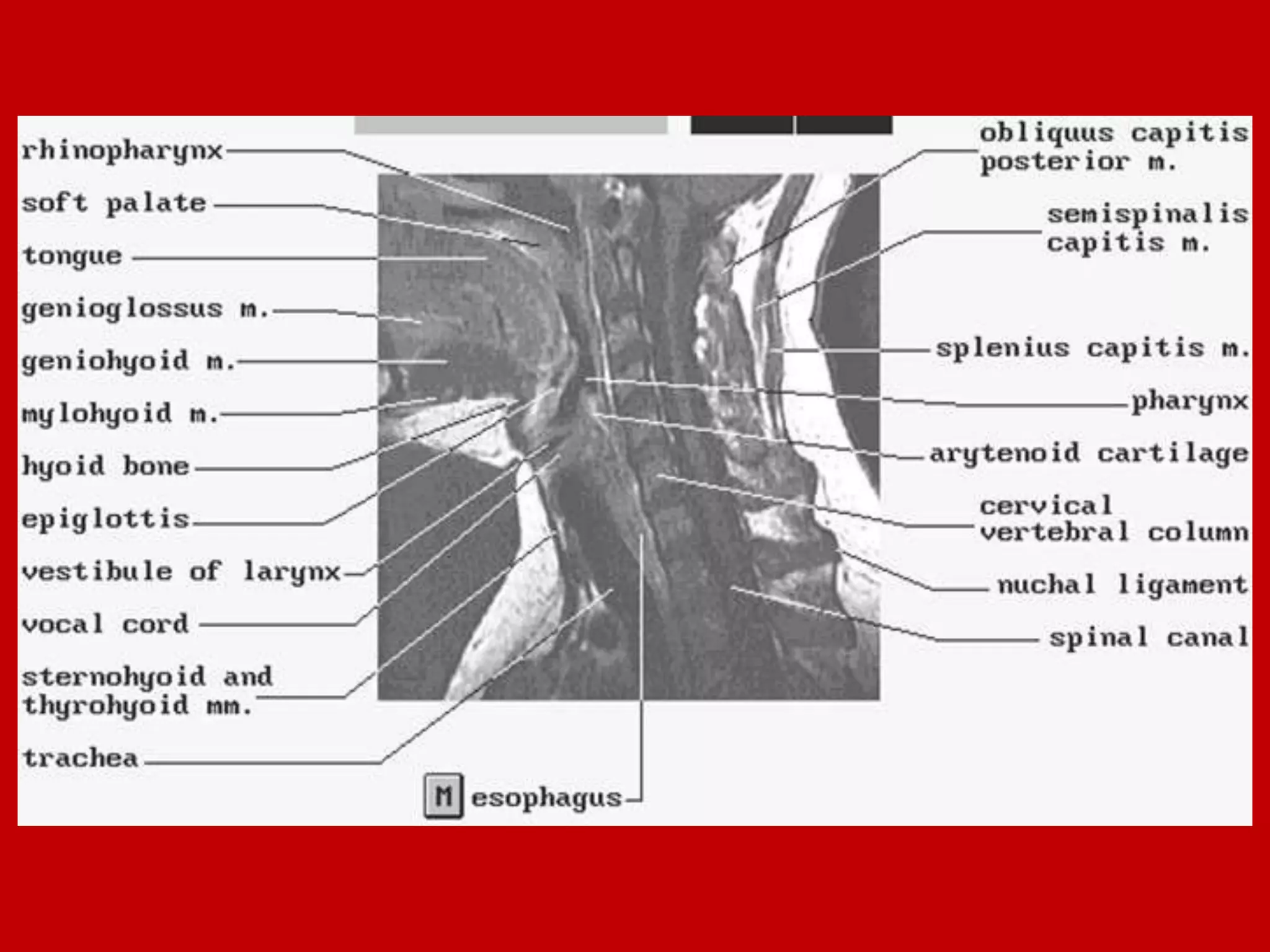larynx Imaging 1st part laryngeal anatomy CT MRI Dr Ahmed Esawy | PDF