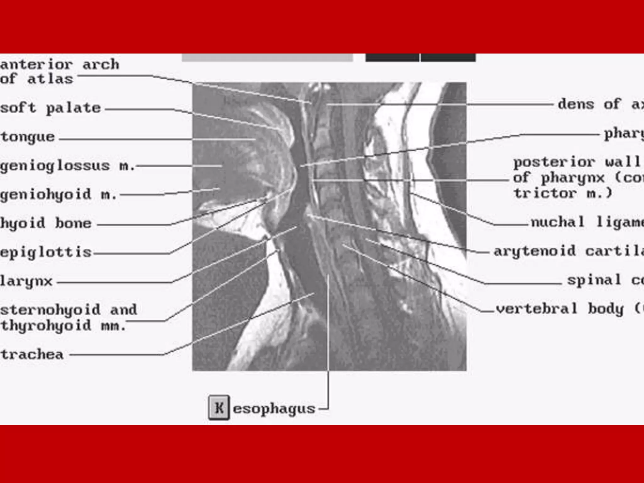 larynx Imaging 1st part laryngeal anatomy CT MRI Dr Ahmed Esawy | PDF