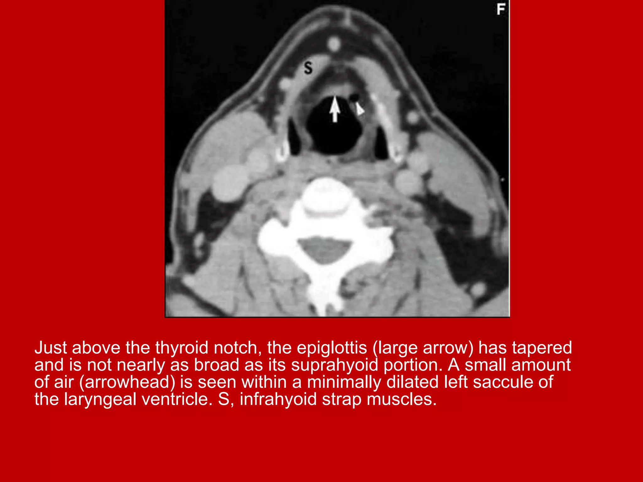 larynx Imaging 1st part laryngeal anatomy CT MRI Dr Ahmed Esawy | PDF