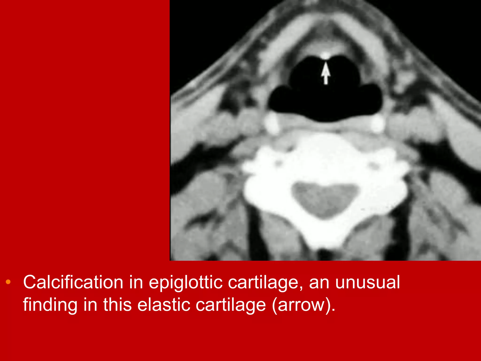 larynx Imaging 1st part laryngeal anatomy CT MRI Dr Ahmed Esawy | PDF