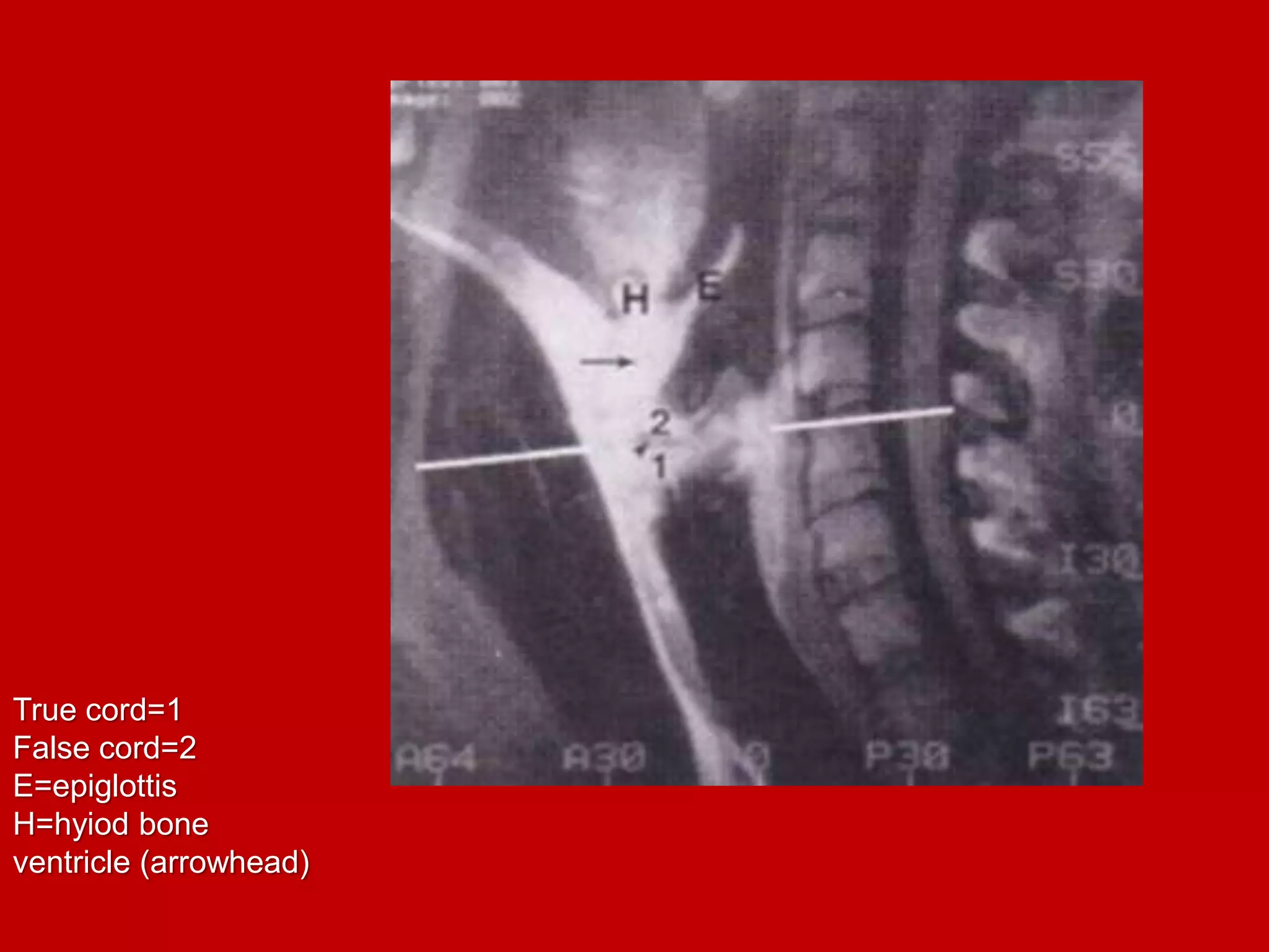 larynx Imaging 1st part laryngeal anatomy CT MRI Dr Ahmed Esawy | PDF