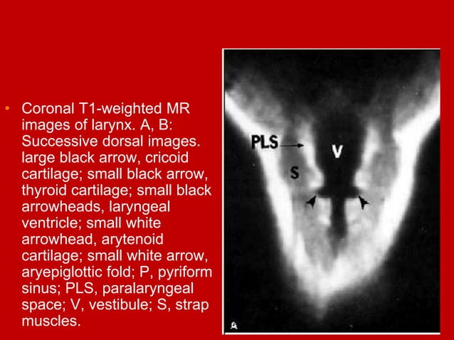 larynx Imaging 1st part laryngeal anatomy CT MRI Dr Ahmed Esawy | PDF