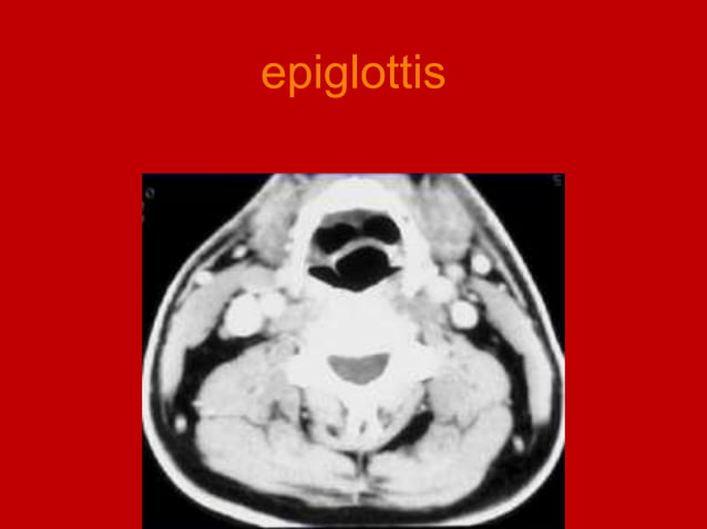 larynx Imaging 1st part laryngeal anatomy CT MRI Dr Ahmed Esawy | PDF