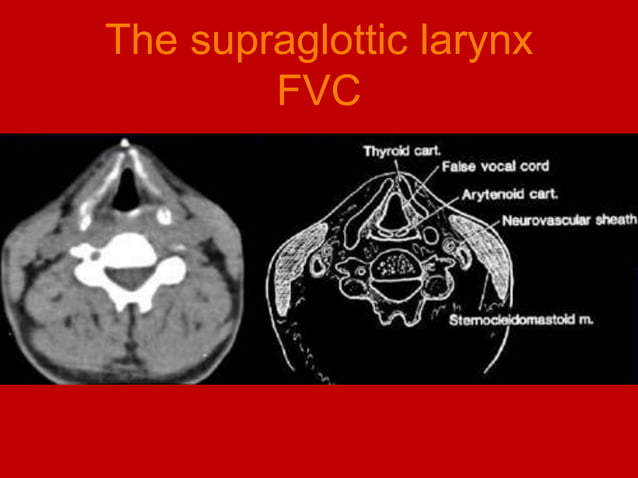larynx Imaging 1st part laryngeal anatomy CT MRI Dr Ahmed Esawy | PDF