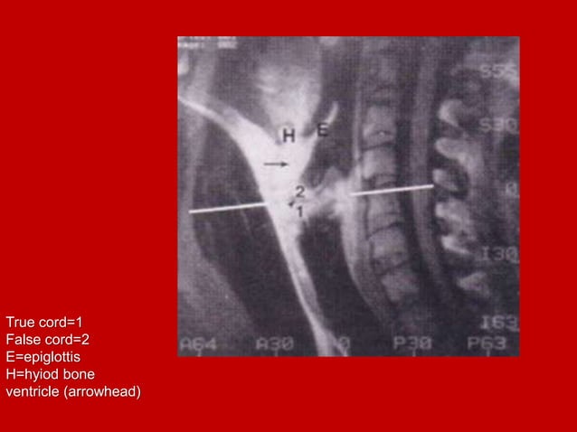 larynx Imaging 1st part laryngeal anatomy CT MRI Dr Ahmed Esawy | PDF